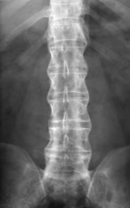 Espondilitis anquilosante