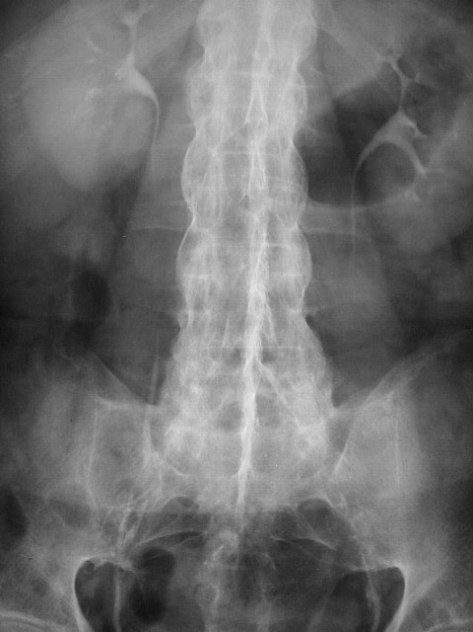 Espondilitis anquilosante