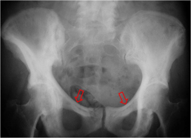 Signo Del Psoas Radiología Peritonitis: Causas, Síntomas Y
