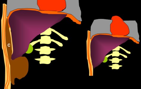 Otros signos de abdomen